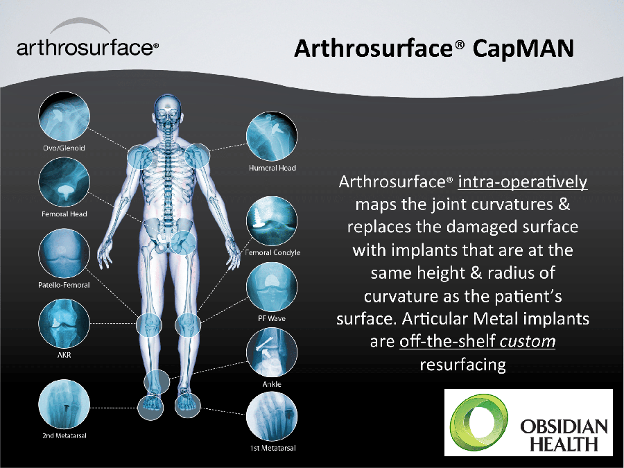 Arthrosurface products | Obsidian